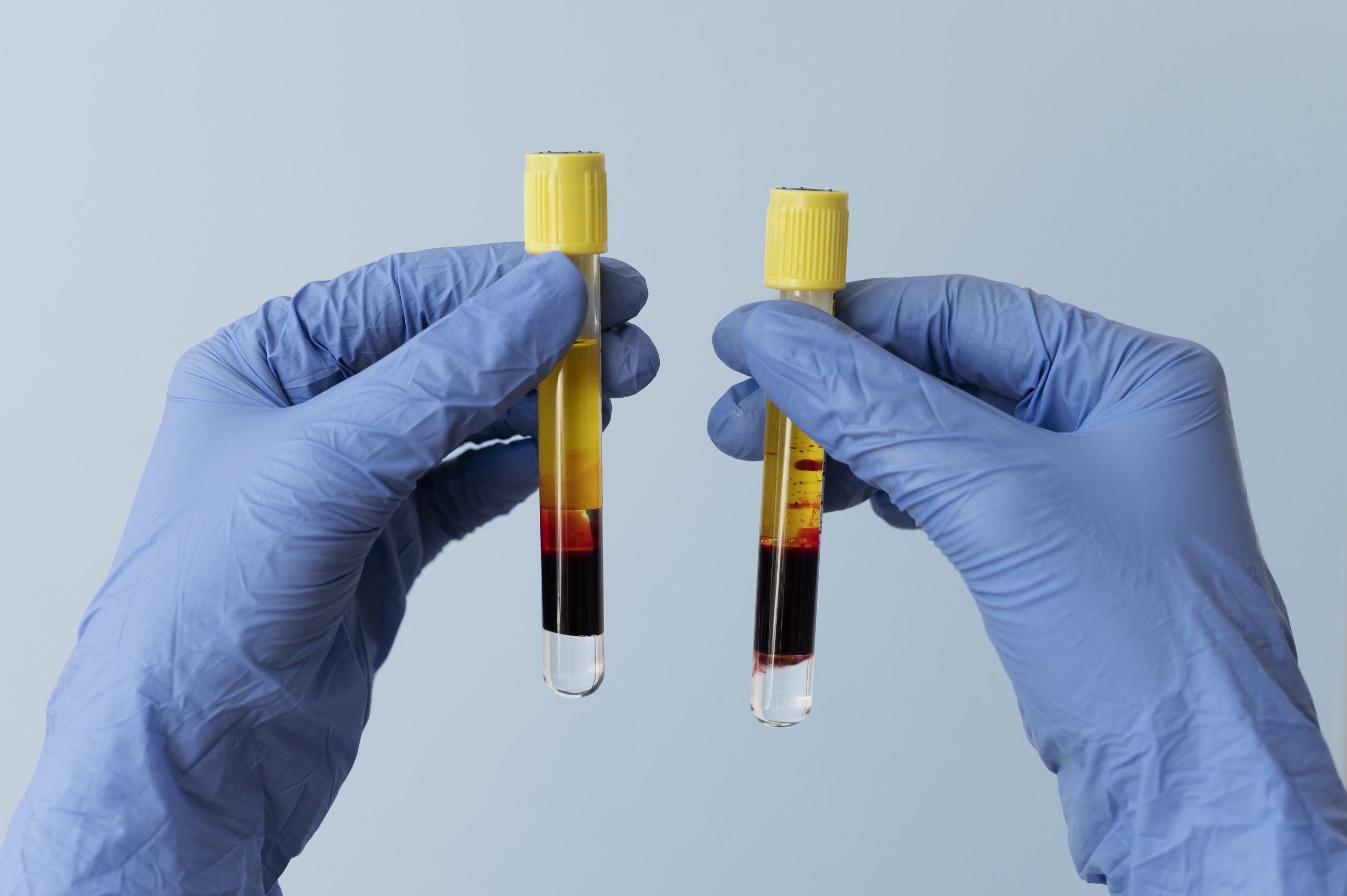How PRP Therapy Works? - Lasting Impressions Laser